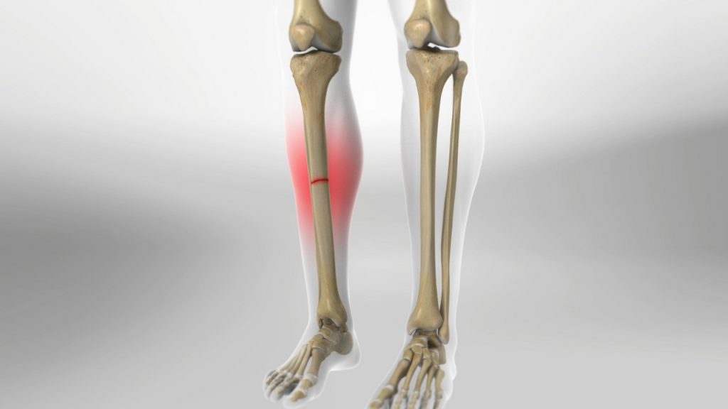 🦴 Rehabilitation After Tibial Fracture: A Comprehensive Guide 📚