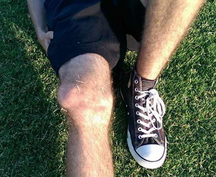 Rehabilitation After Patellar Fracture: Video Exercises for Recovery ...